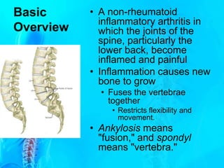Ankylosing Spondylitis | PPTX