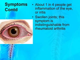 Ankylosing Spondylitis | PPTX