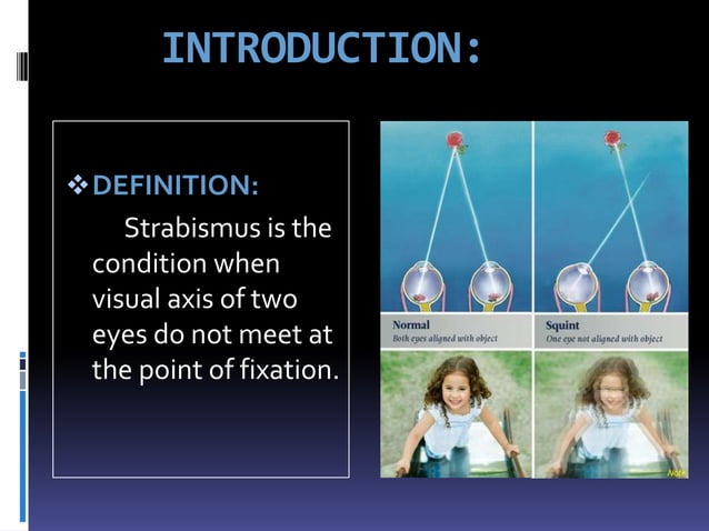 Assesssment of strabismus | PPTX | Eye and Vision Conditions | Diseases ...
