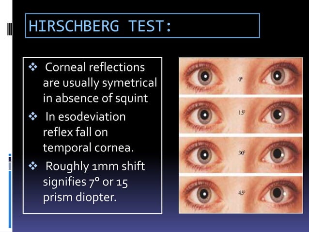 Assesssment of strabismus | PPTX | Eye and Vision Conditions | Diseases ...