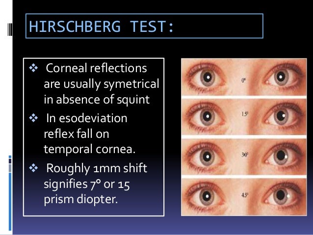 Assesssment of strabismus