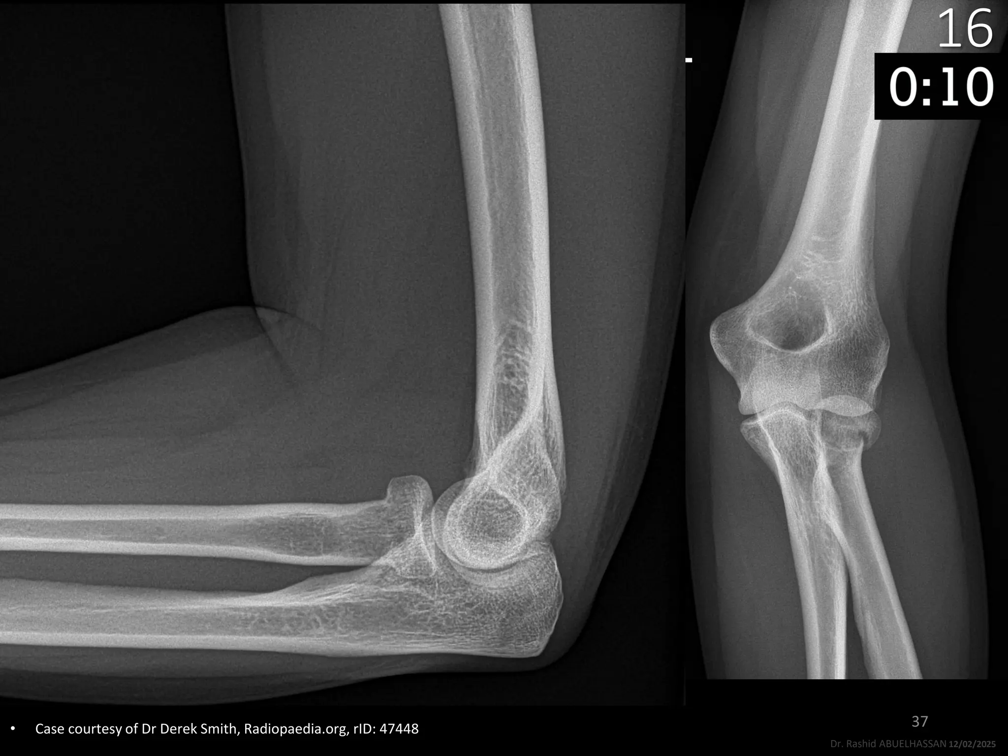 Assessment and Care of Simple Fractures and Dislocations in ED (Part1 ...