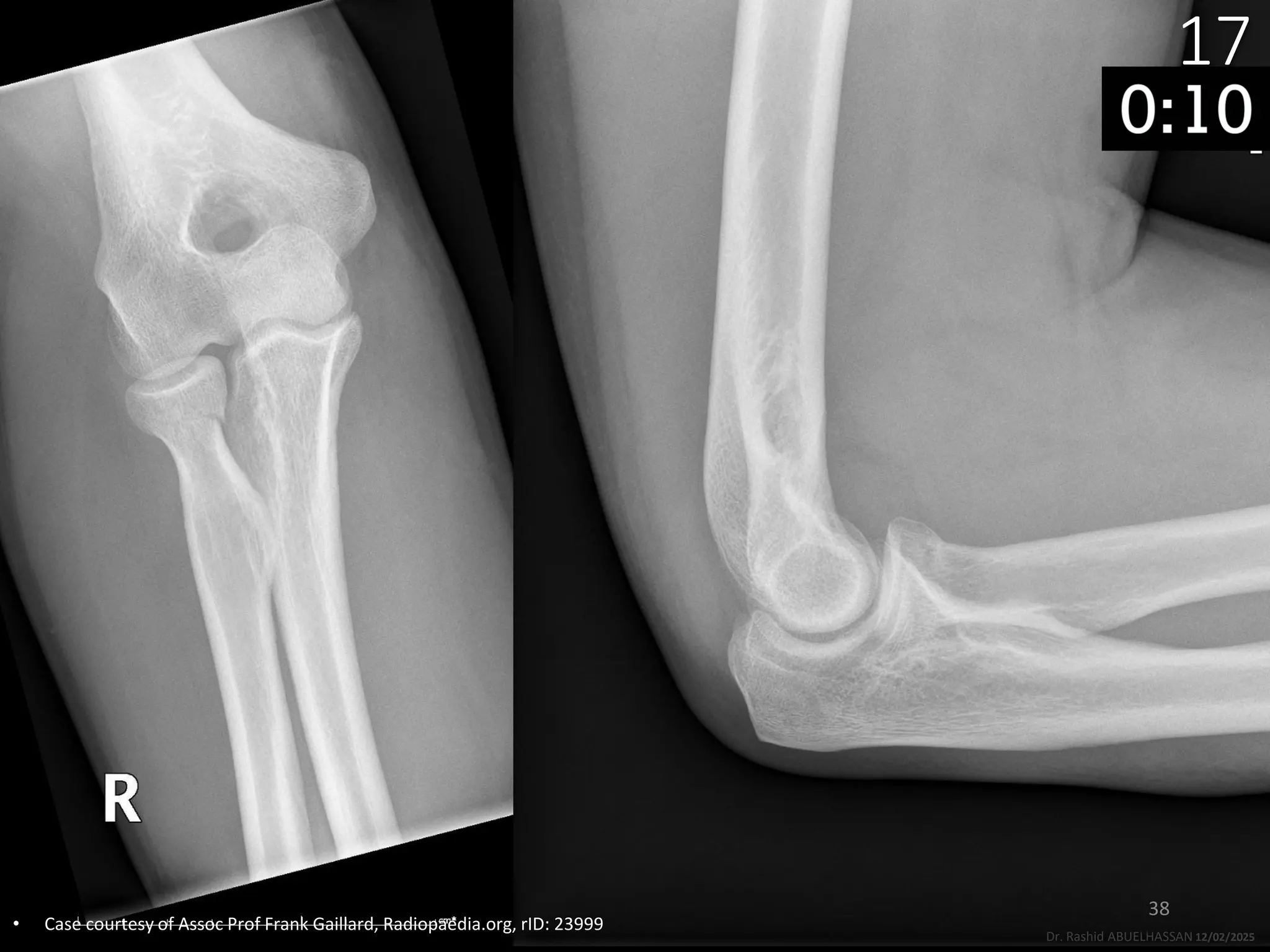 Assessment and Care of Simple Fractures and Dislocations in ED (Part1 ...
