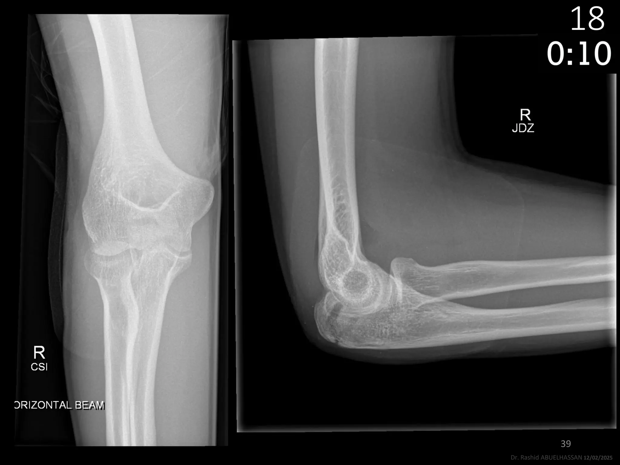 Assessment and Care of Simple Fractures and Dislocations in ED (Part1 ...