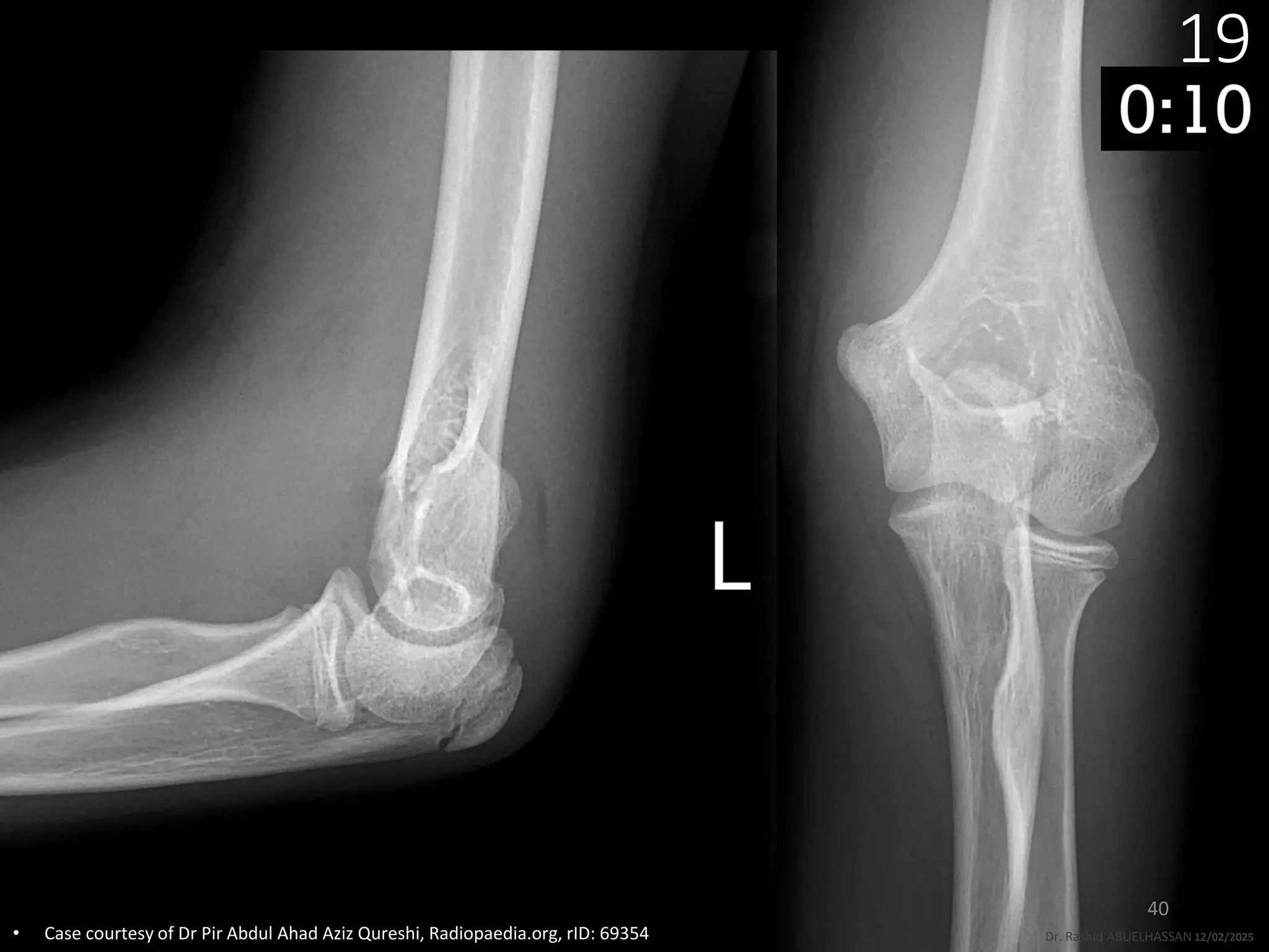 Assessment and Care of Simple Fractures and Dislocations in ED (Part1 ...