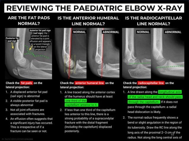 Assessment and Care of Simple Fractures and Dislocations in ED (Part1 ...