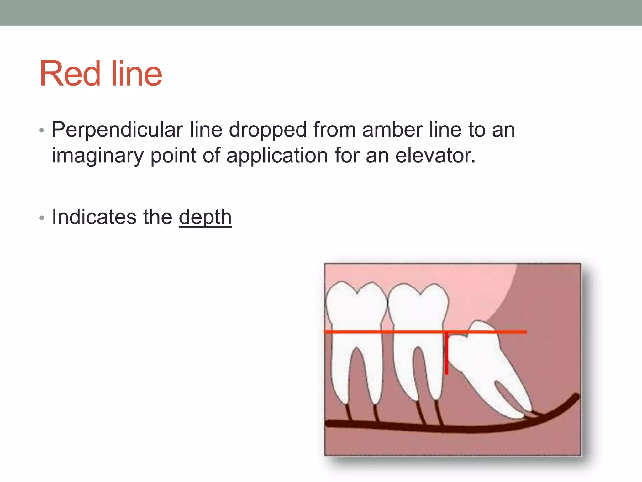 Assessment of difficulty of mandibular impacted third molar | PPTX