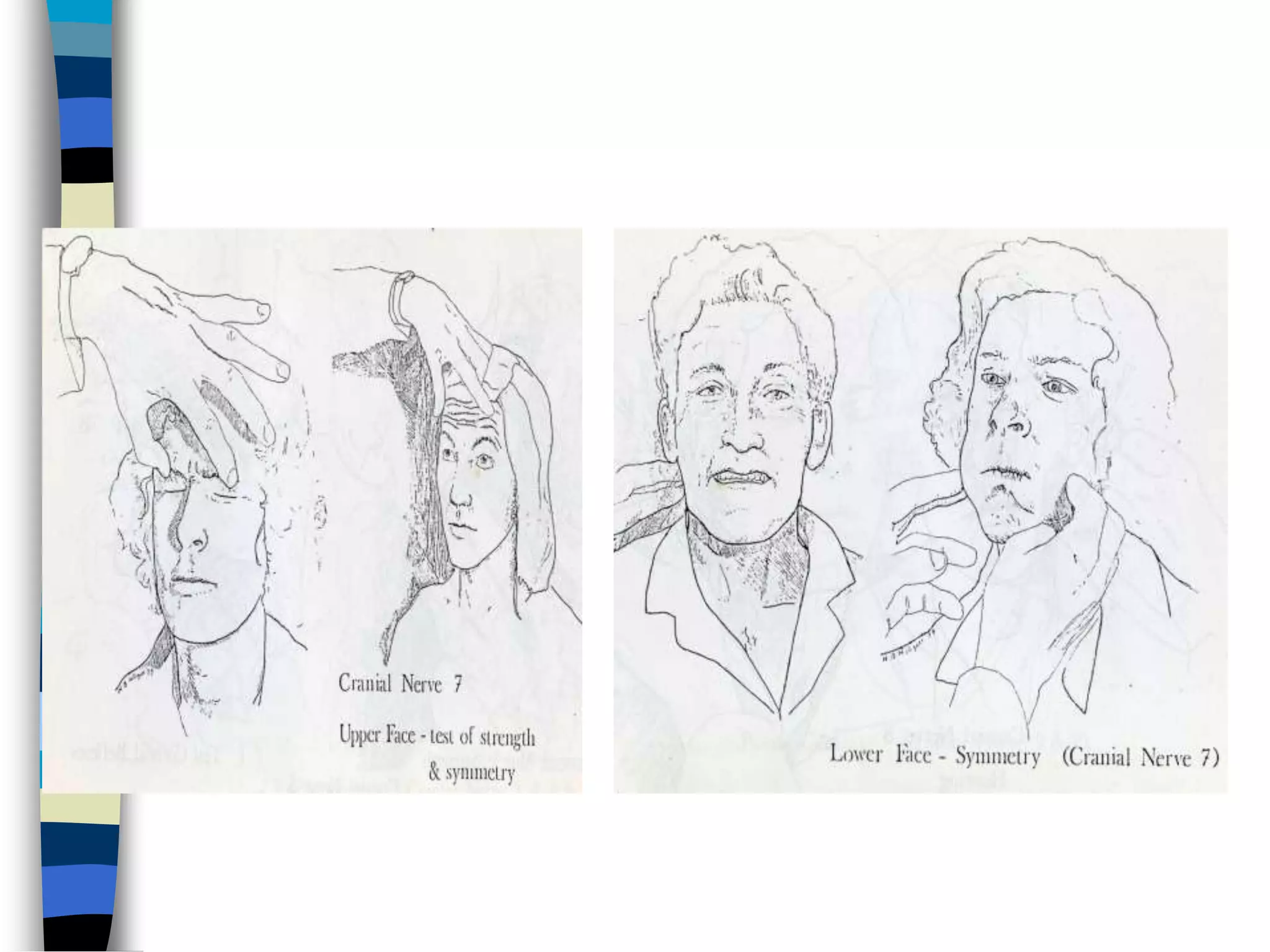 Assesment, interpretation n management of cranial nerve dysfunction | PPTX