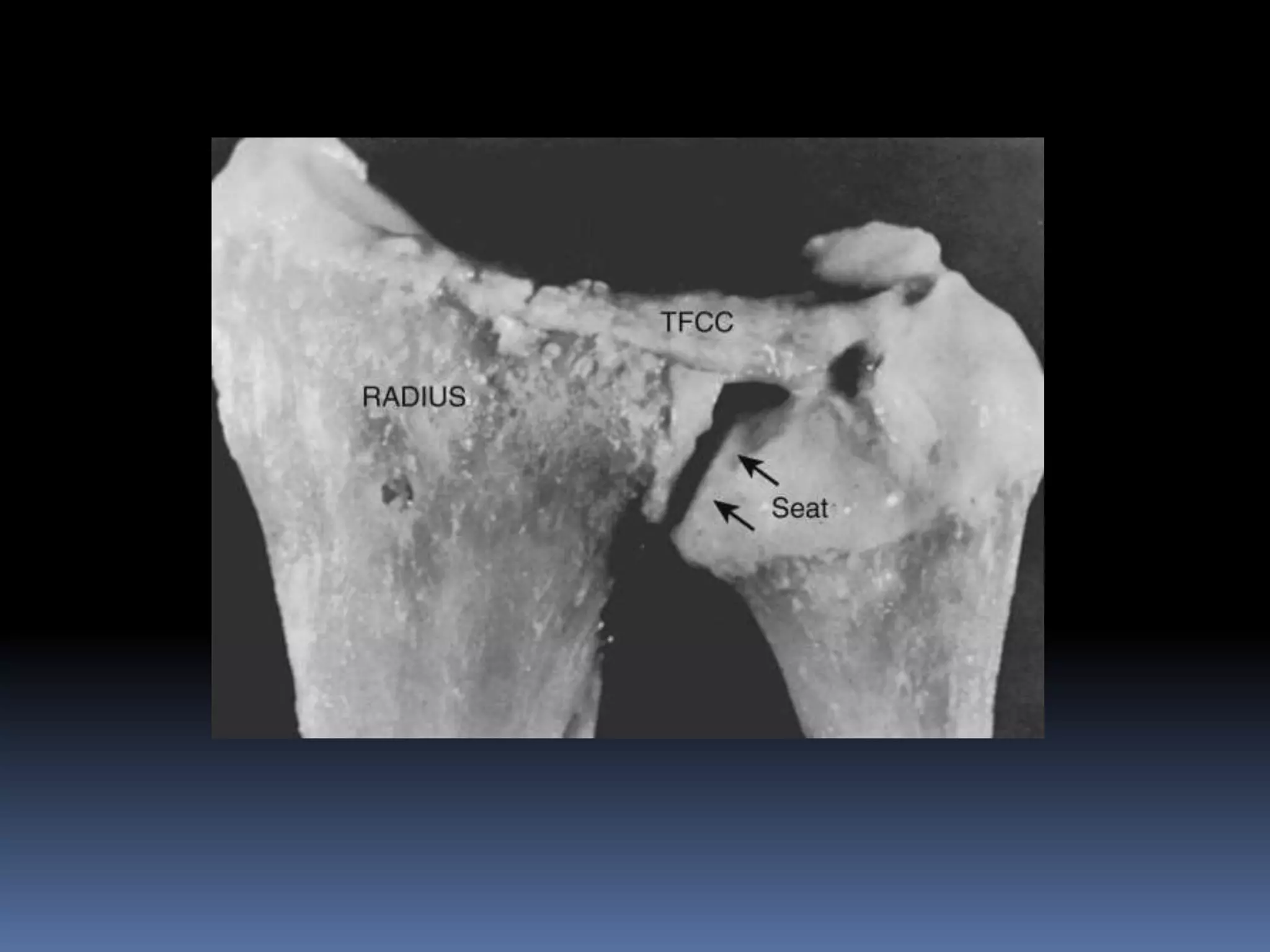Assessent and radiology of distal end radius fracture | PPTX