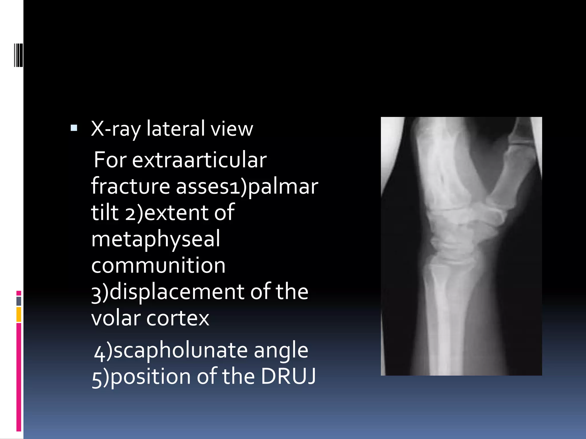 Assessent and radiology of distal end radius fracture | PPTX