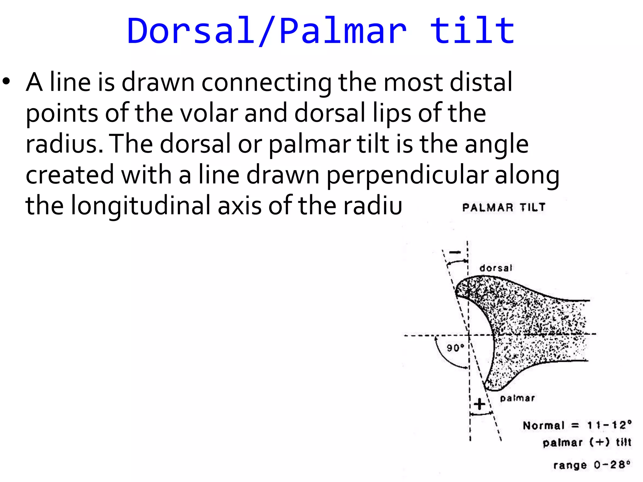 Assessent and radiology of distal end radius fracture | PPTX
