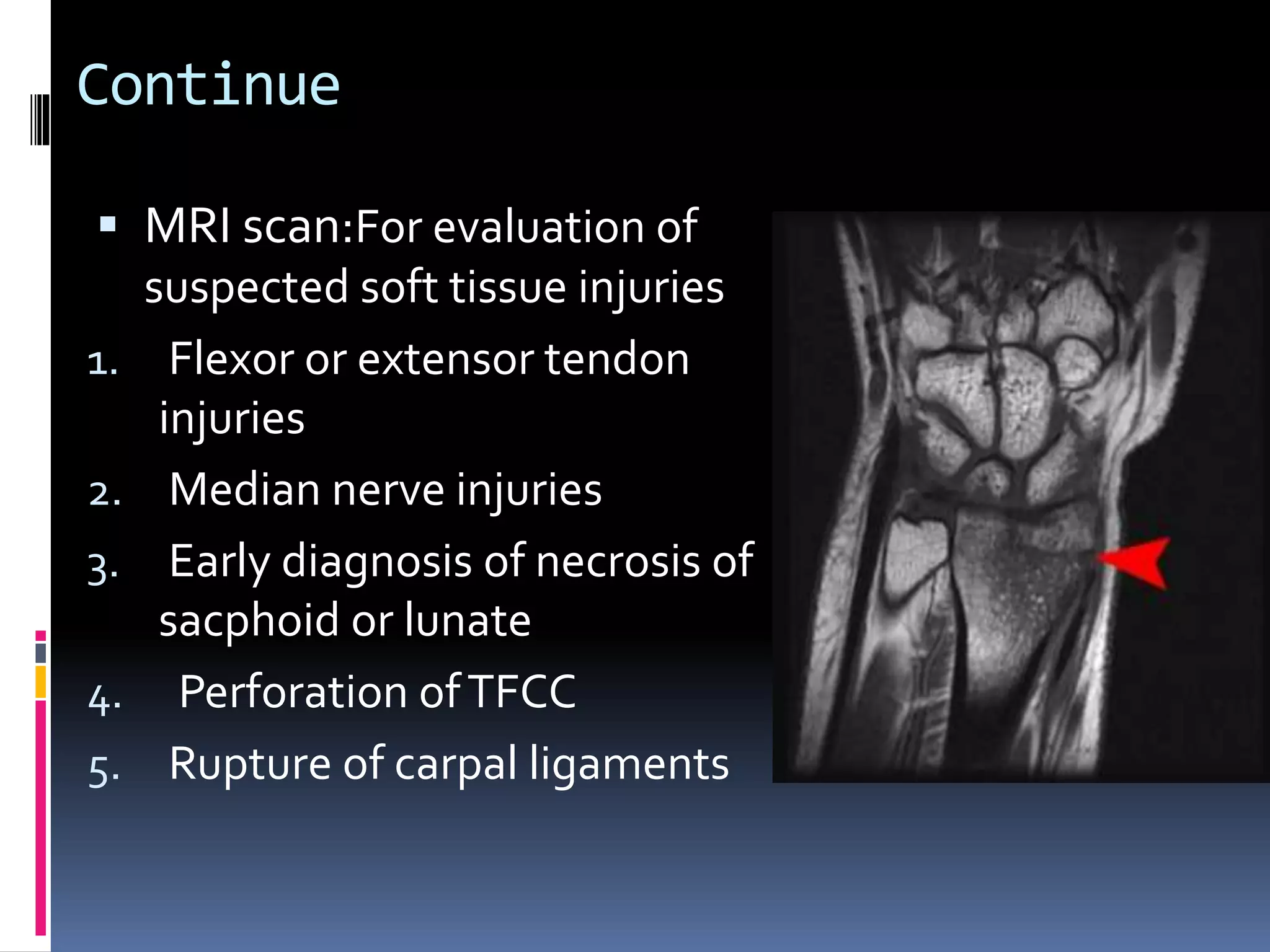 Assessent and radiology of distal end radius fracture | PPTX