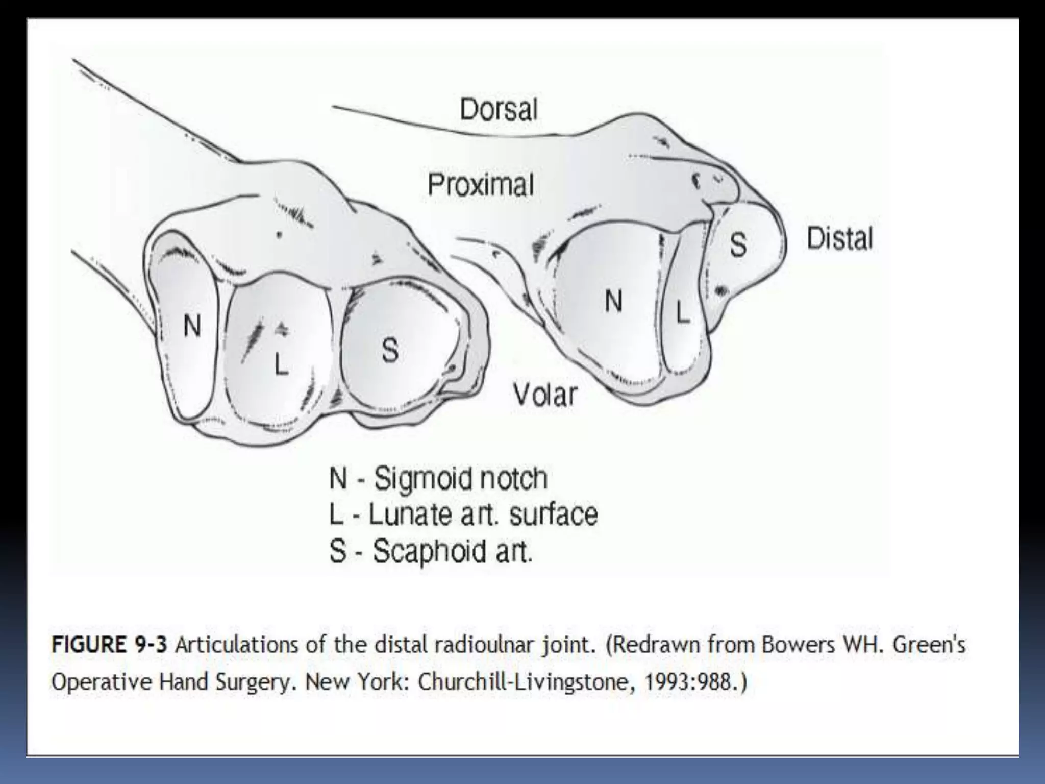 Assessent and radiology of distal end radius fracture | PPTX