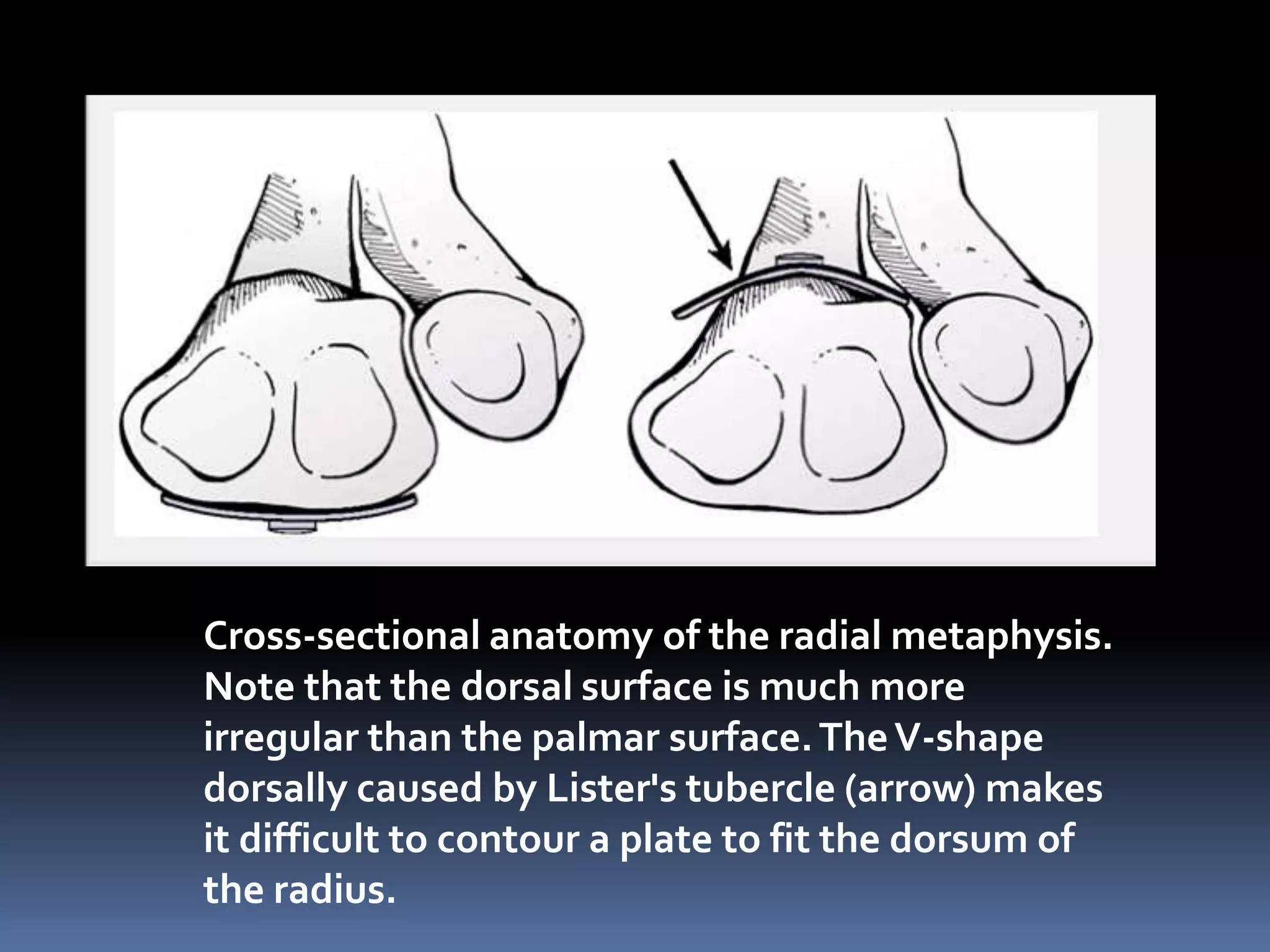 Assessent and radiology of distal end radius fracture | PPTX