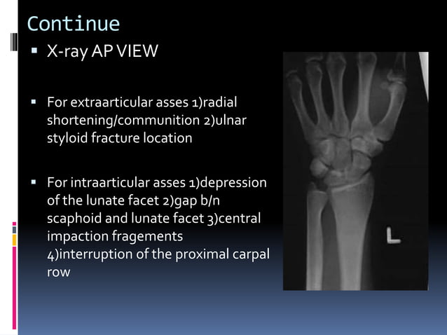 Assessent and radiology of distal end radius fracture | PPTX