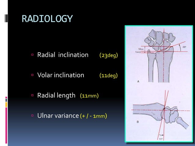 Assessent and radiology of distal end radius fracture | PPTX