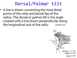 Assessent and radiology of distal end radius fracture | PPTX