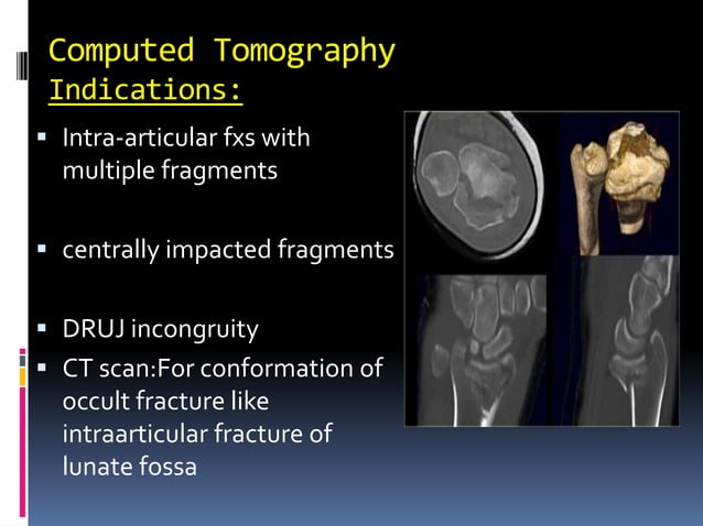 Assessent and radiology of distal end radius fracture | PPTX