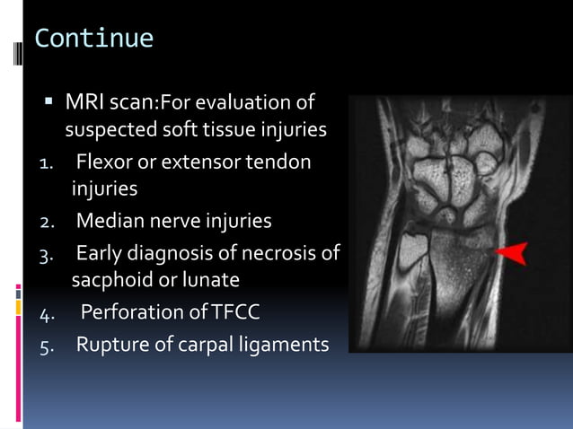 Assessent and radiology of distal end radius fracture | PPTX