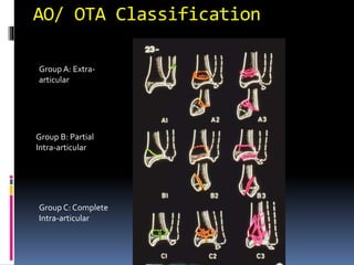 Assessent and radiology of distal end radius fracture | PPTX
