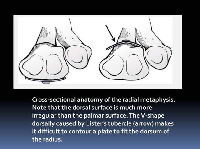 Assessent and radiology of distal end radius fracture | PPTX