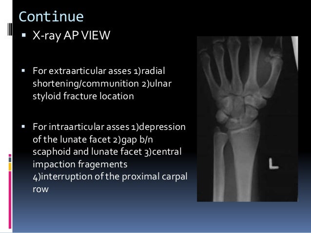 Assessent and radiology of distal end radius fracture