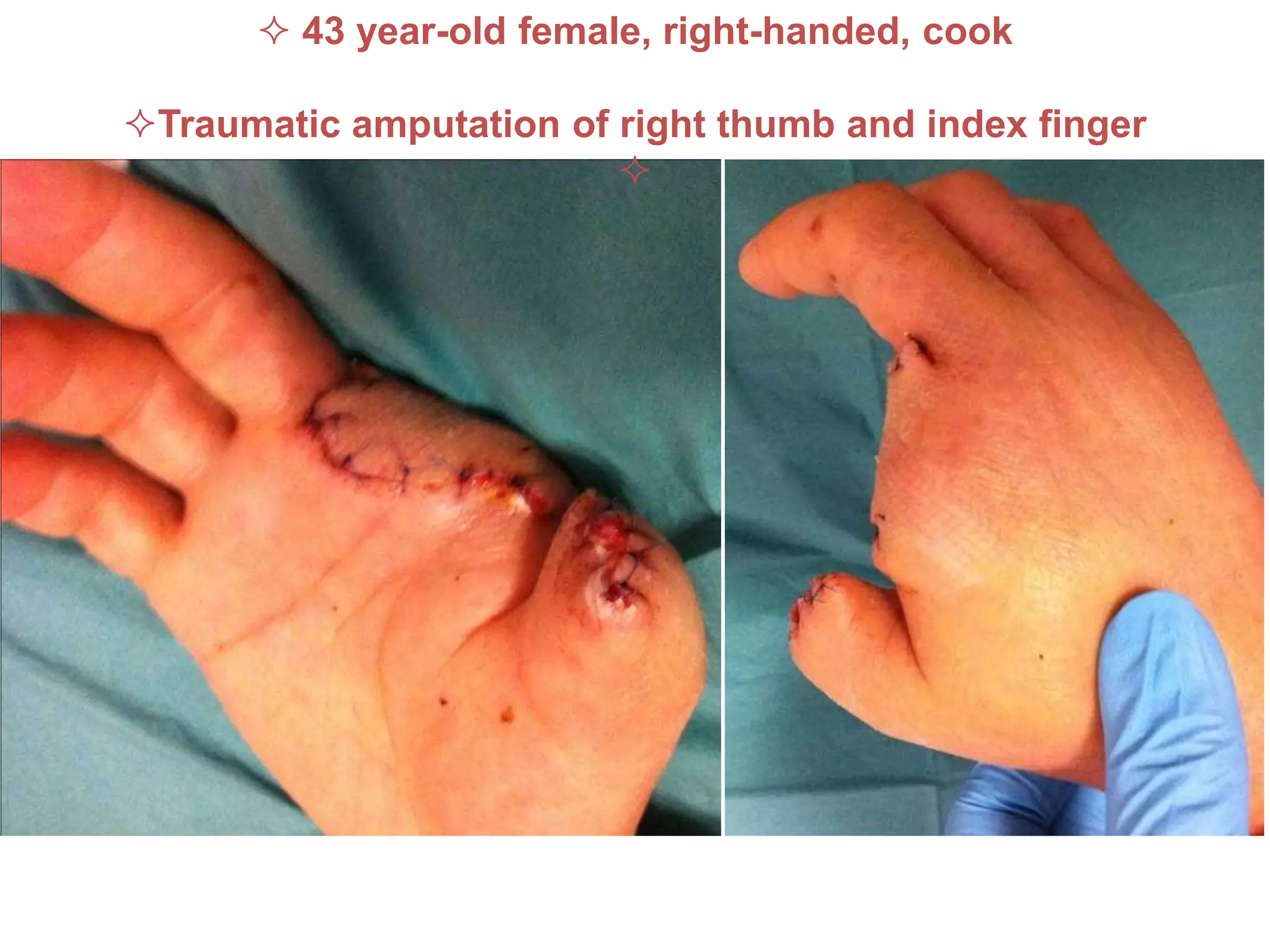 Assessing disability – world health organization disability assessment ...