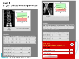 Assessing Fracture Risk | PPT