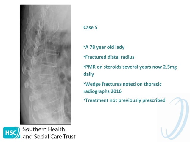 Assessing Fracture Risk | PPT | Bone and Joint Conditions | Diseases ...