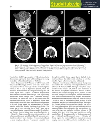 Assessing The Elusive Cognitive Deficits Associated With Ventromedial ...