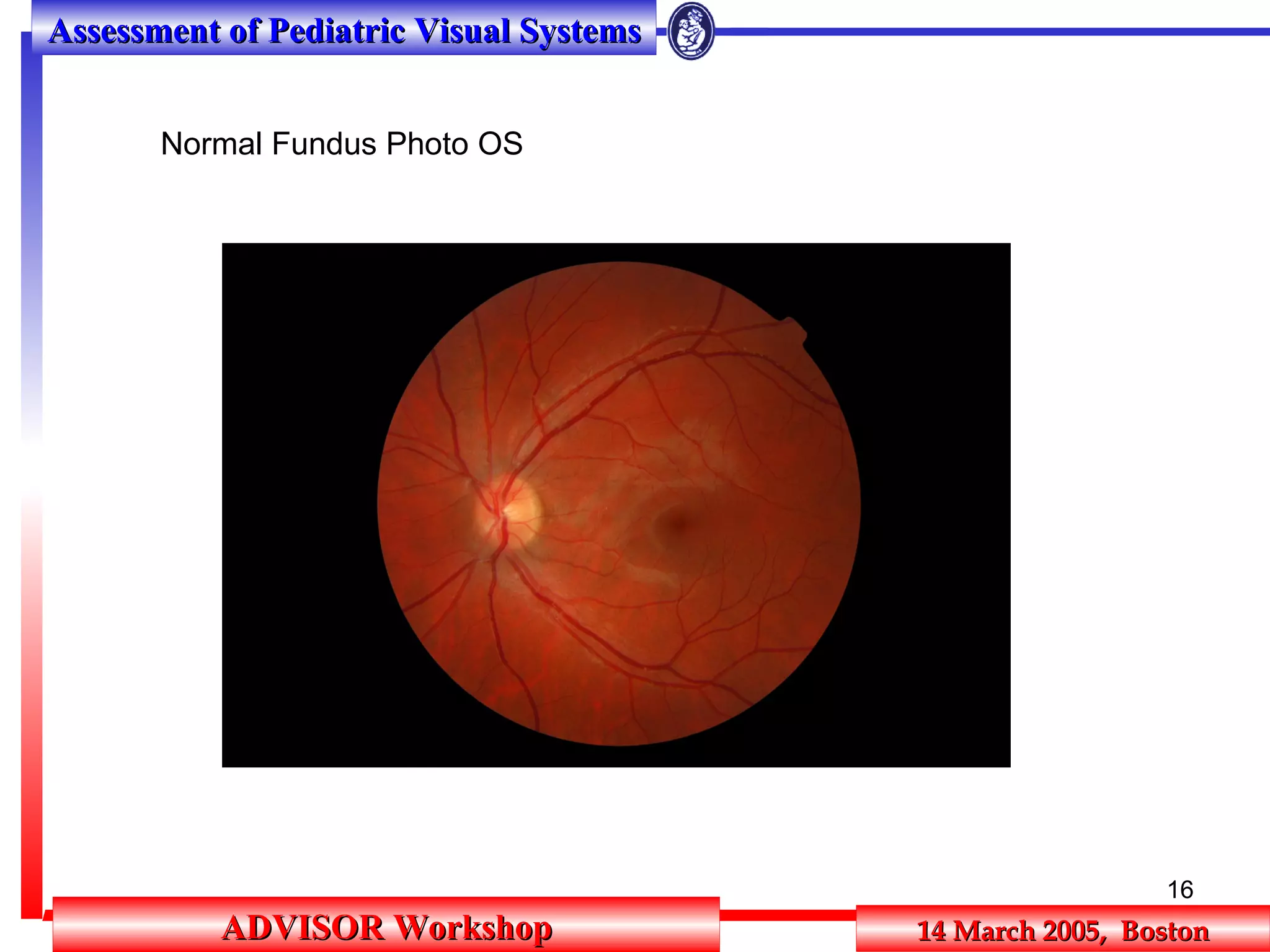 Assessment of the Pediatric Visual System | PPT