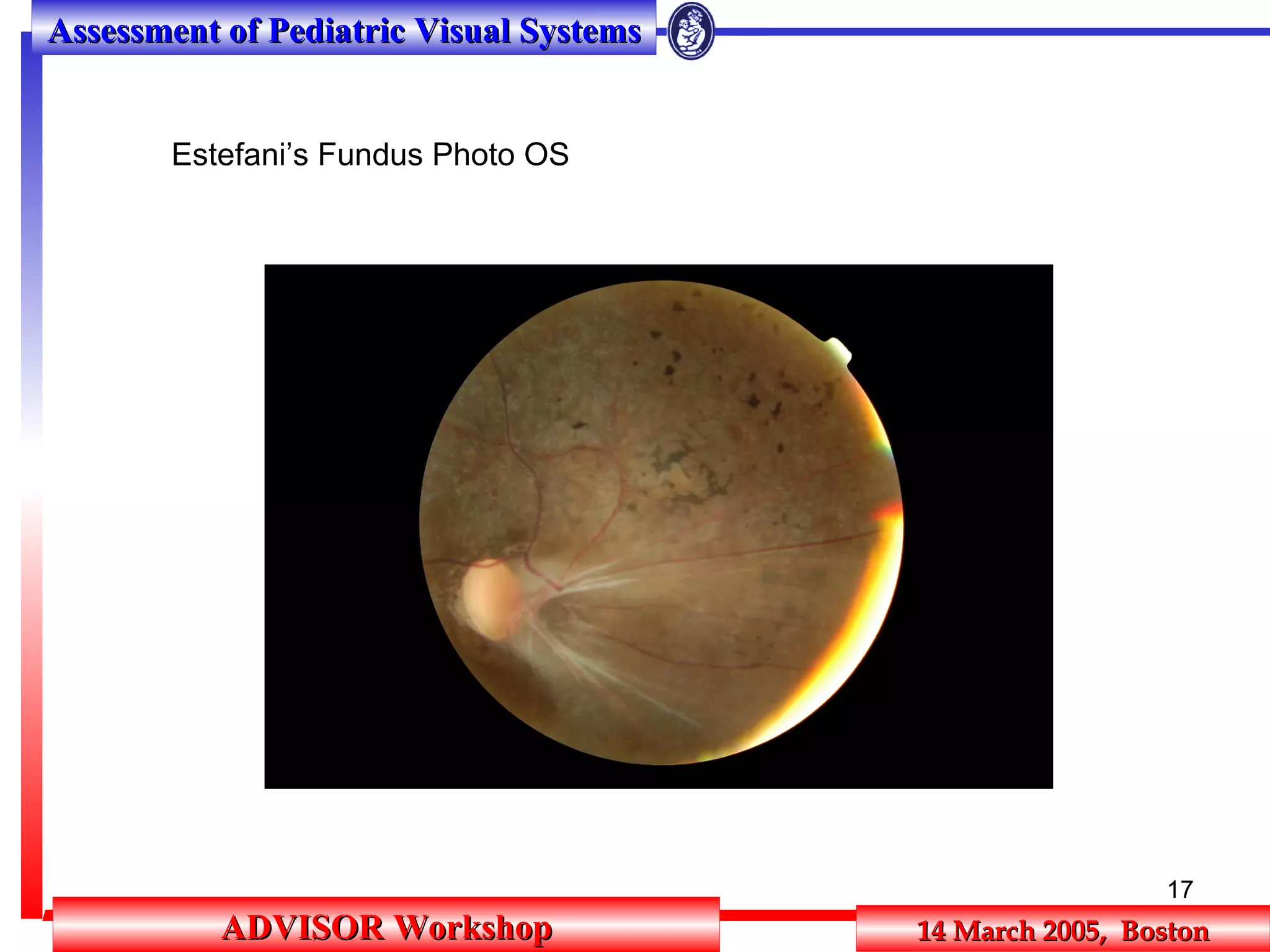 Assessment of the Pediatric Visual System | PPT