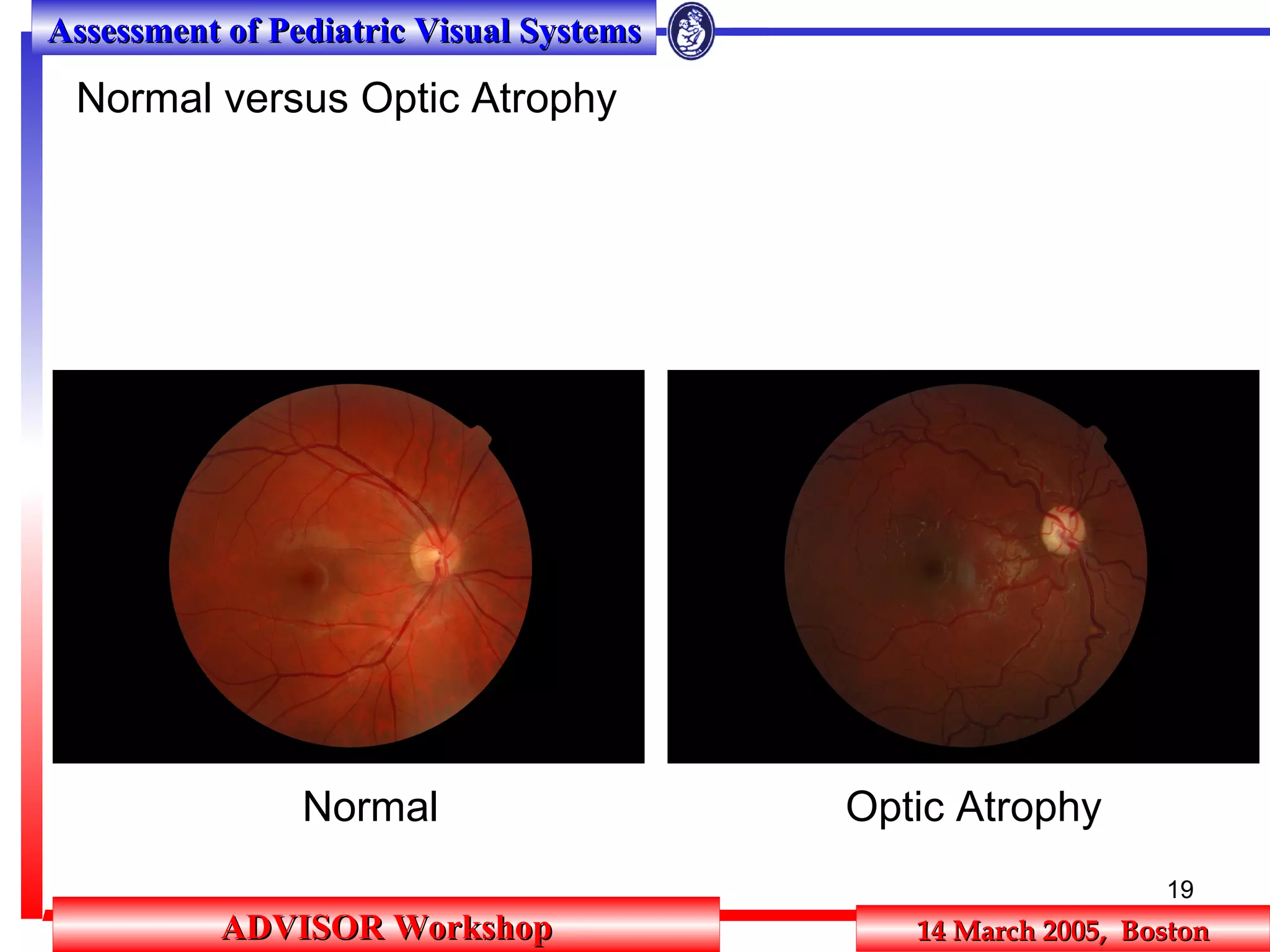 Assessment of the Pediatric Visual System | PPT