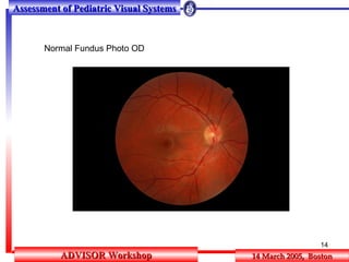 Assessment of the Pediatric Visual System | PPT | Eye and Vision ...