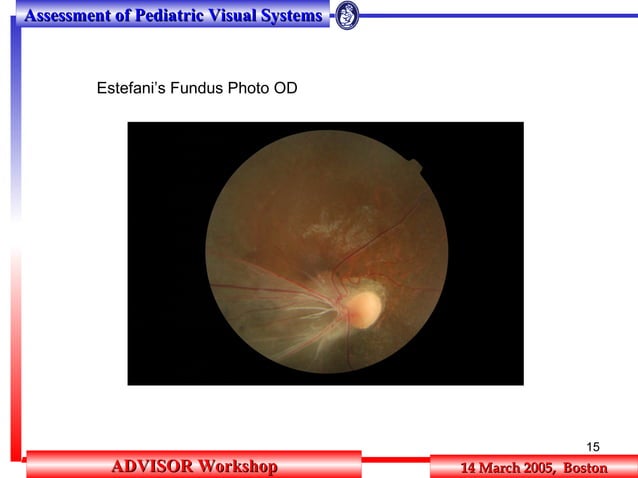 Assessment of the Pediatric Visual System | PPT | Eye and Vision ...