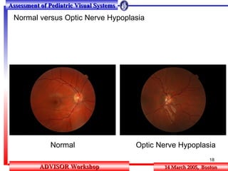 Assessment of the Pediatric Visual System | PPT | Eye and Vision ...