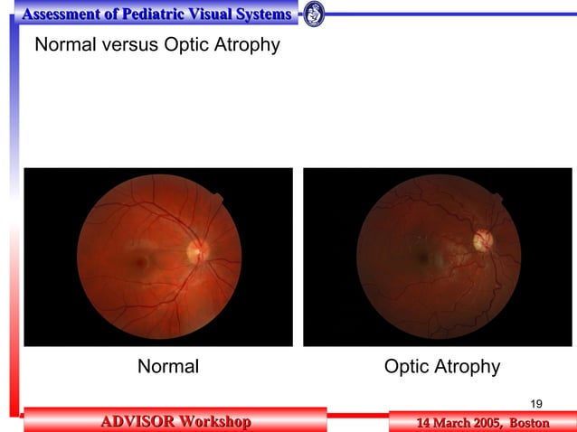 Assessment of the Pediatric Visual System | PPT