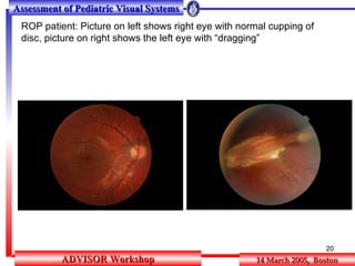 Assessment of the Pediatric Visual System | PPT | Eye and Vision ...