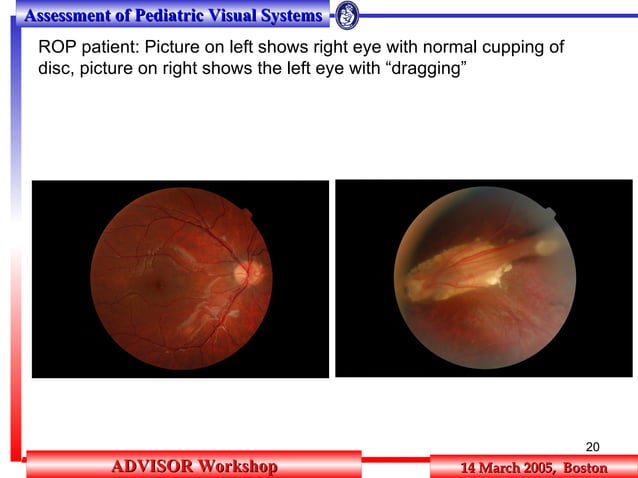 Assessment of the Pediatric Visual System | PPT | Eye and Vision ...