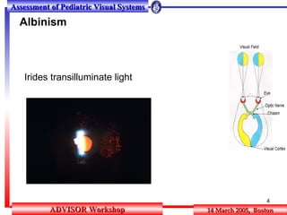Assessment of the Pediatric Visual System | PPT | Eye and Vision ...