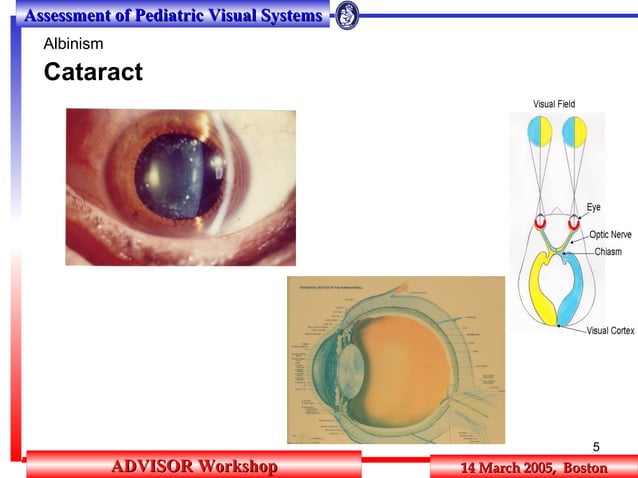 Assessment of the Pediatric Visual System | PPT
