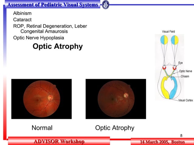 Assessment of the Pediatric Visual System | PPT