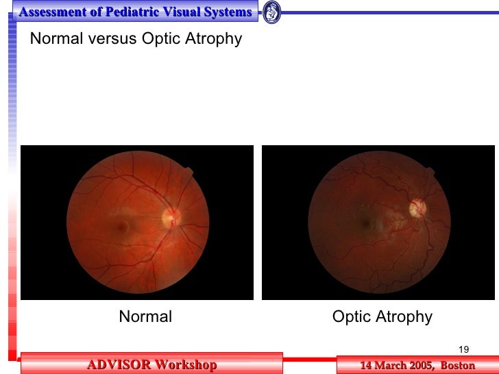 Assessment of the Pediatric Visual System