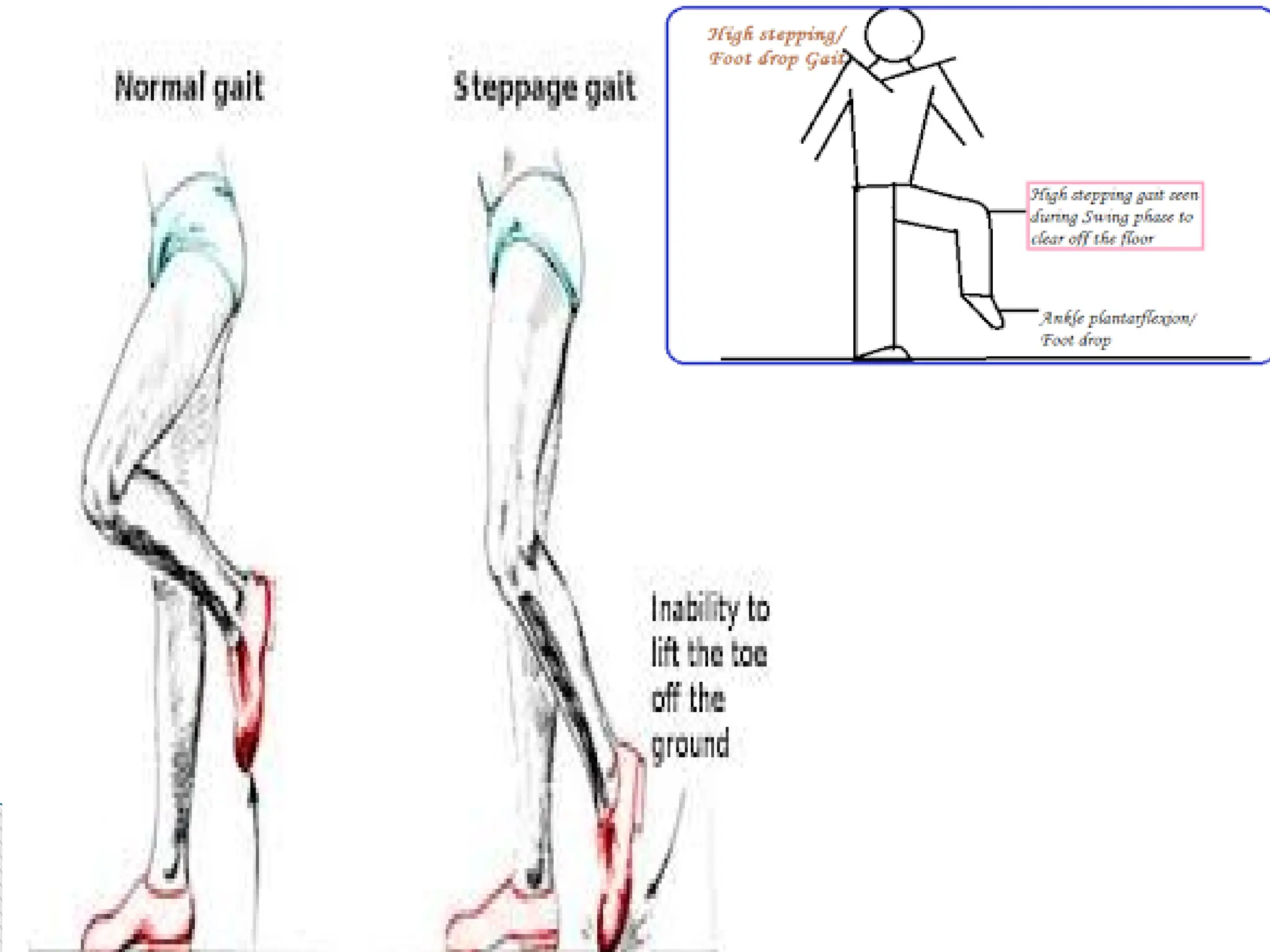 Assessment and physiotherapy management of High step gait.pptx | Physical Therapy | Wellness