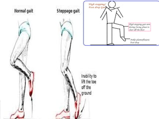 Assessment and physiotherapy management of High step gait.pptx