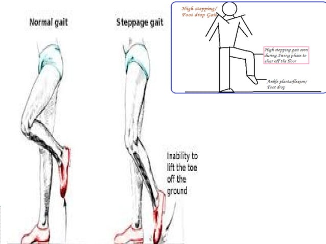 Assessment and physiotherapy management of High step gait.pptx ...