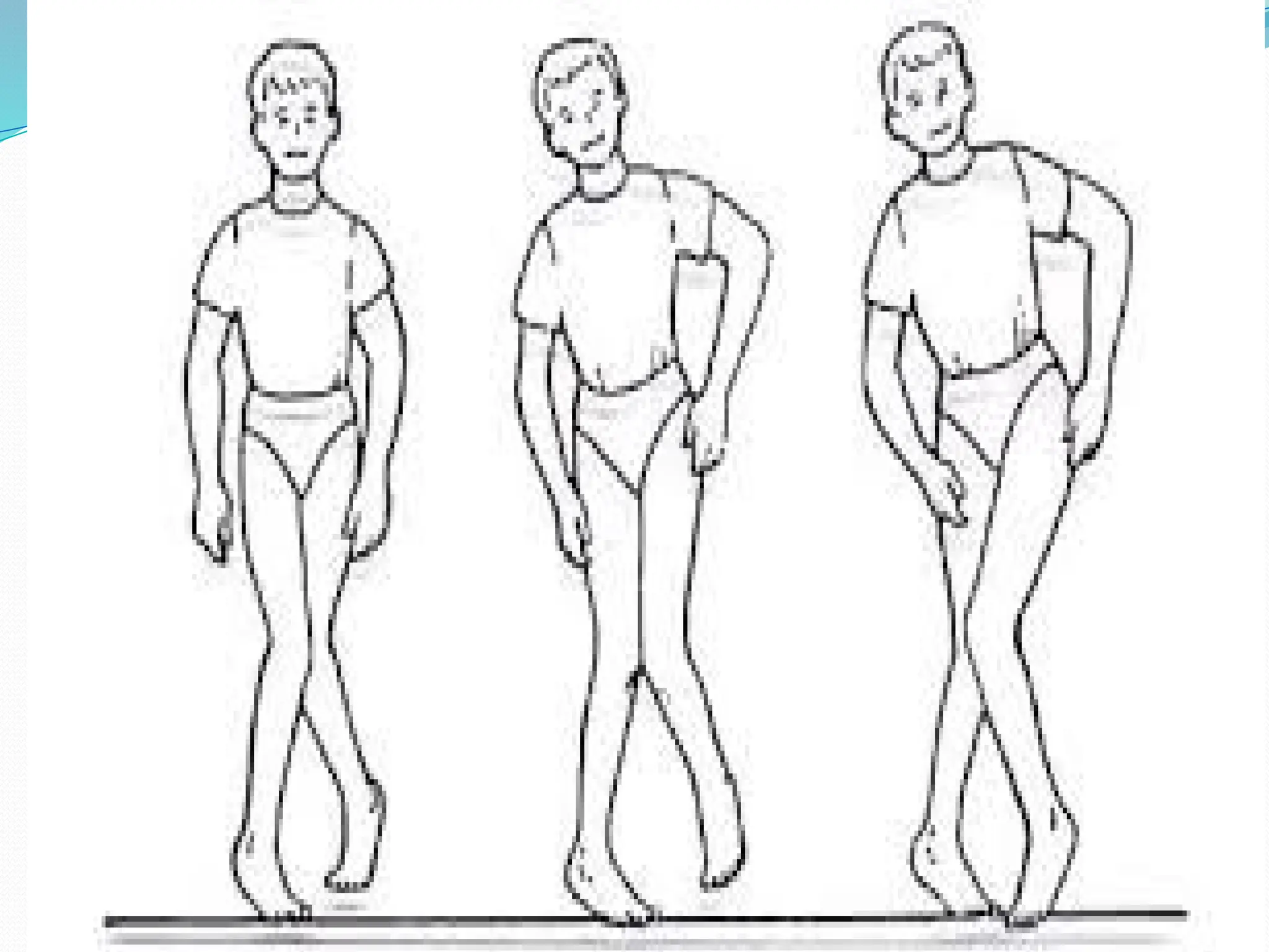 Assessment and physiotherapy management of Scissoring Gait.pptx