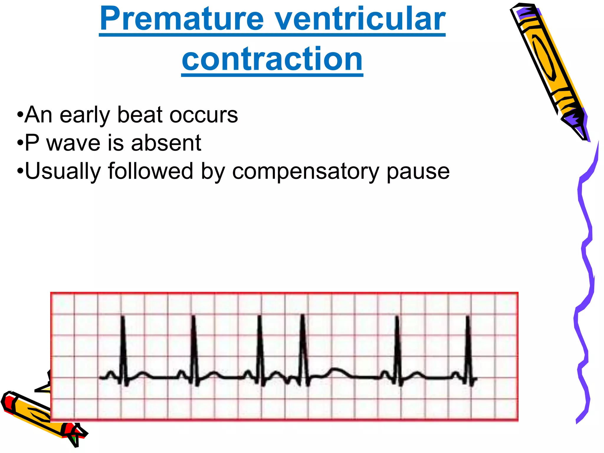Assessment and risk stratification for cardiac rehabilitation | PPTX