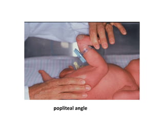 Assessment in Newborn | PPT