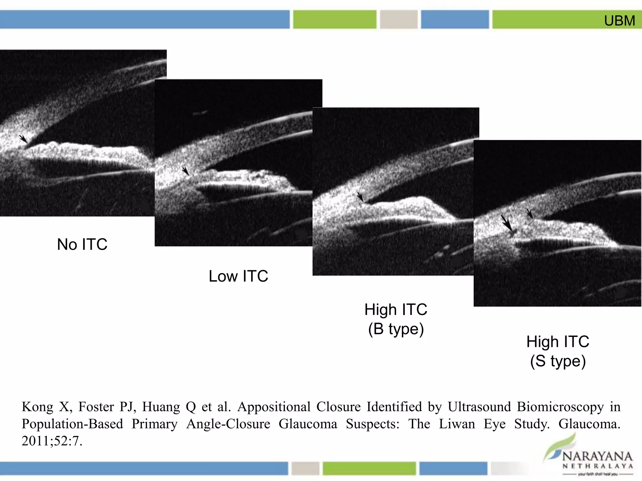 Assessment of Anterior Chamber Angle | PPTX